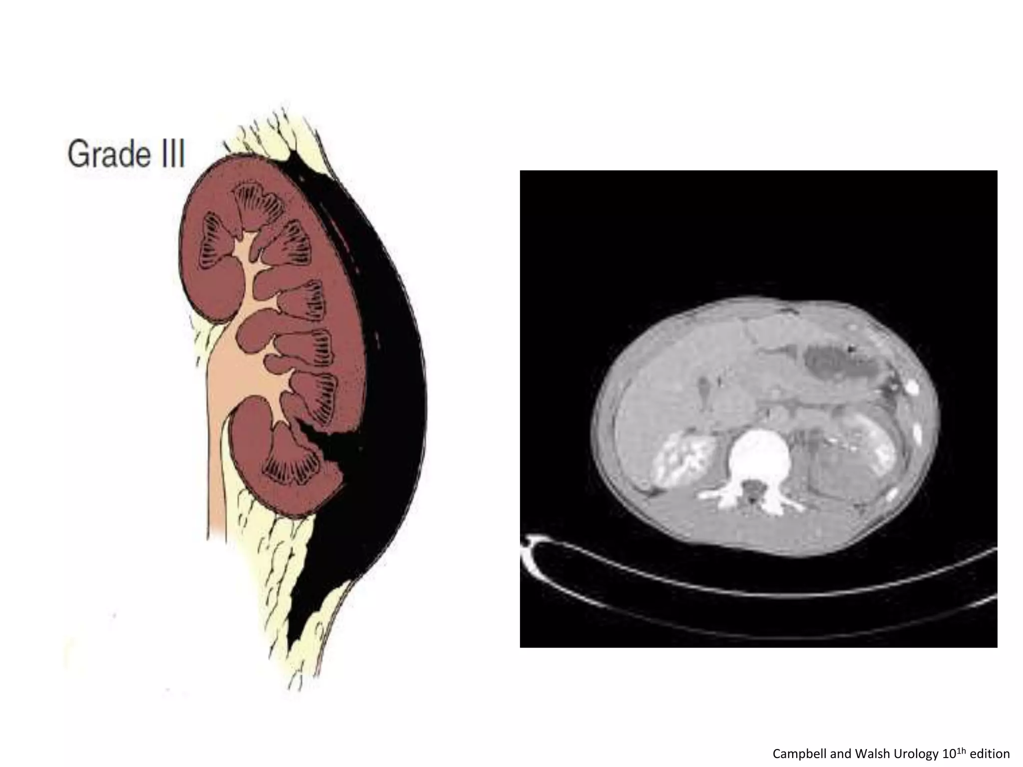 Renal trauma kidney injury | PPTX