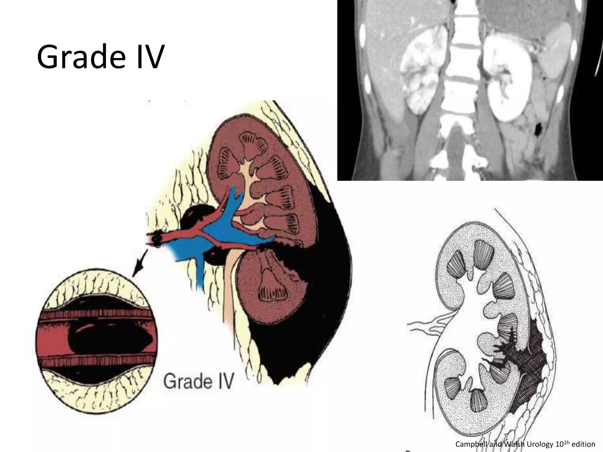 Renal trauma kidney injury | PPTX