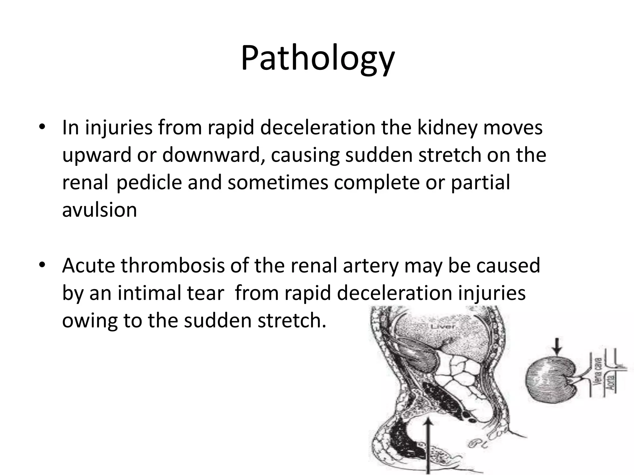 Renal trauma kidney injury | PPTX