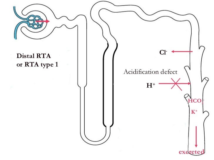 Renal tubular acidosis