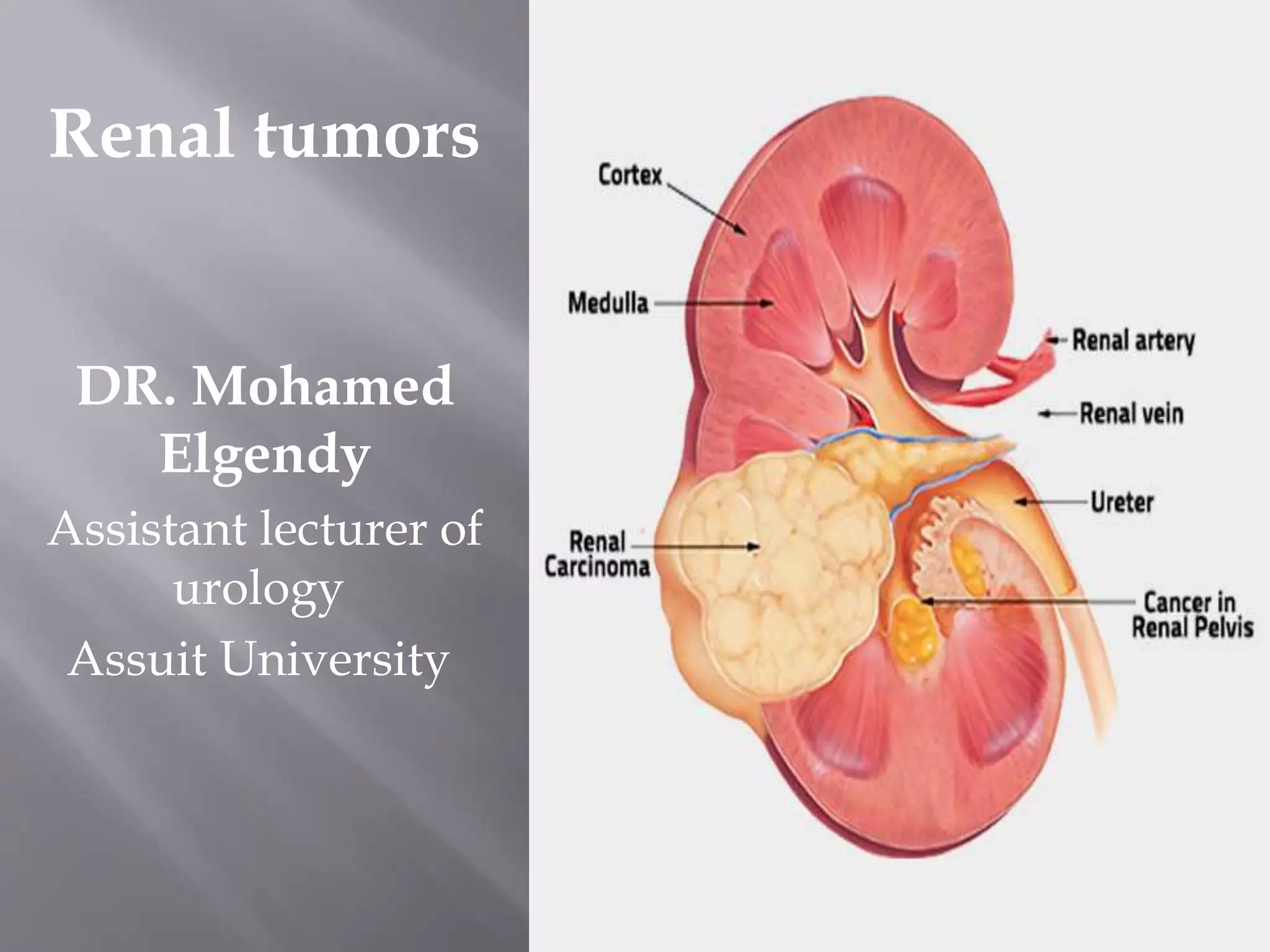 CT Urogram Highly Sensitive for Detecting Renal Tumors | PPT