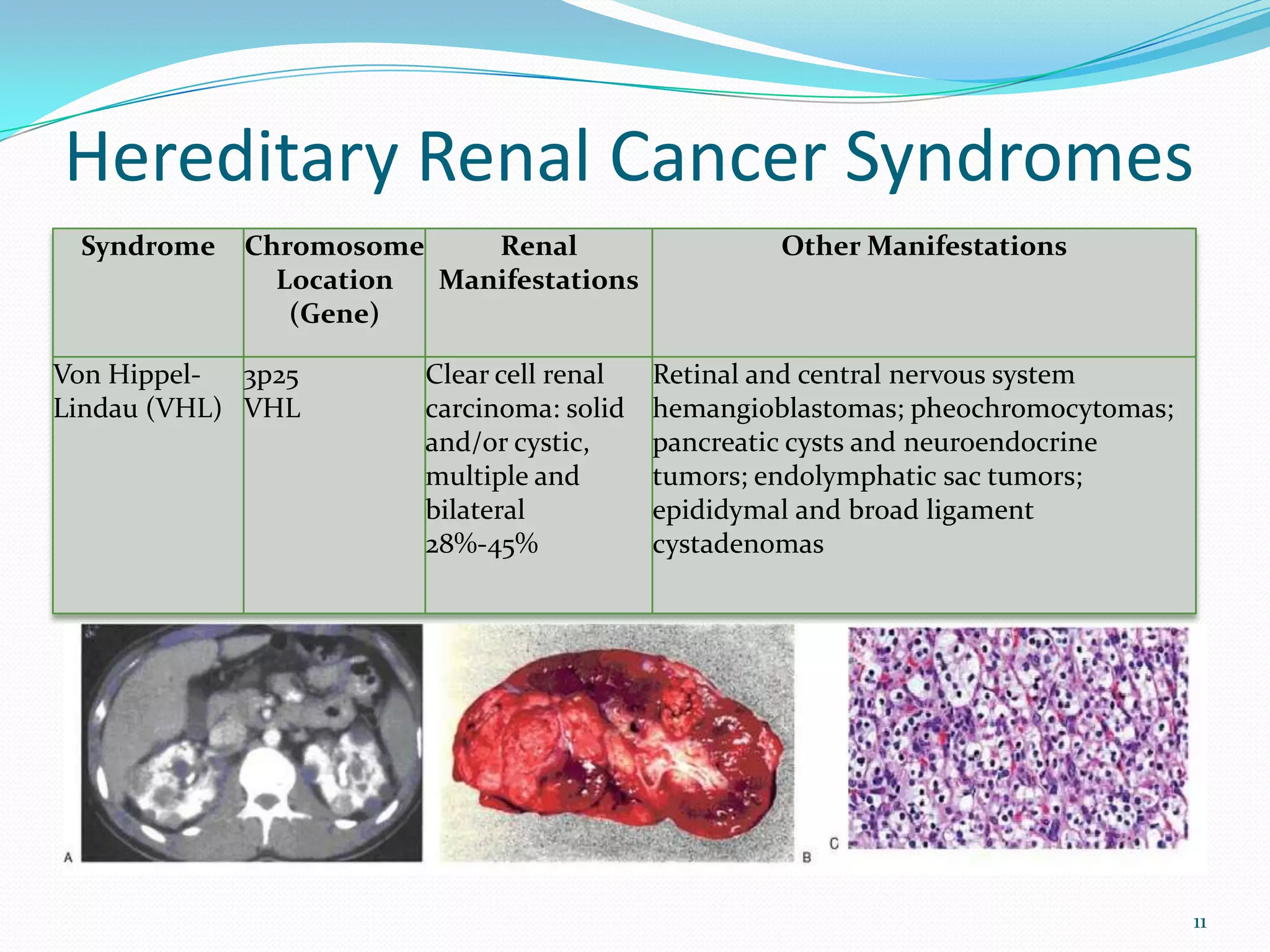 Renal Tumors, Renal Cell Carcinoma- Dr. Vandana | PPT
