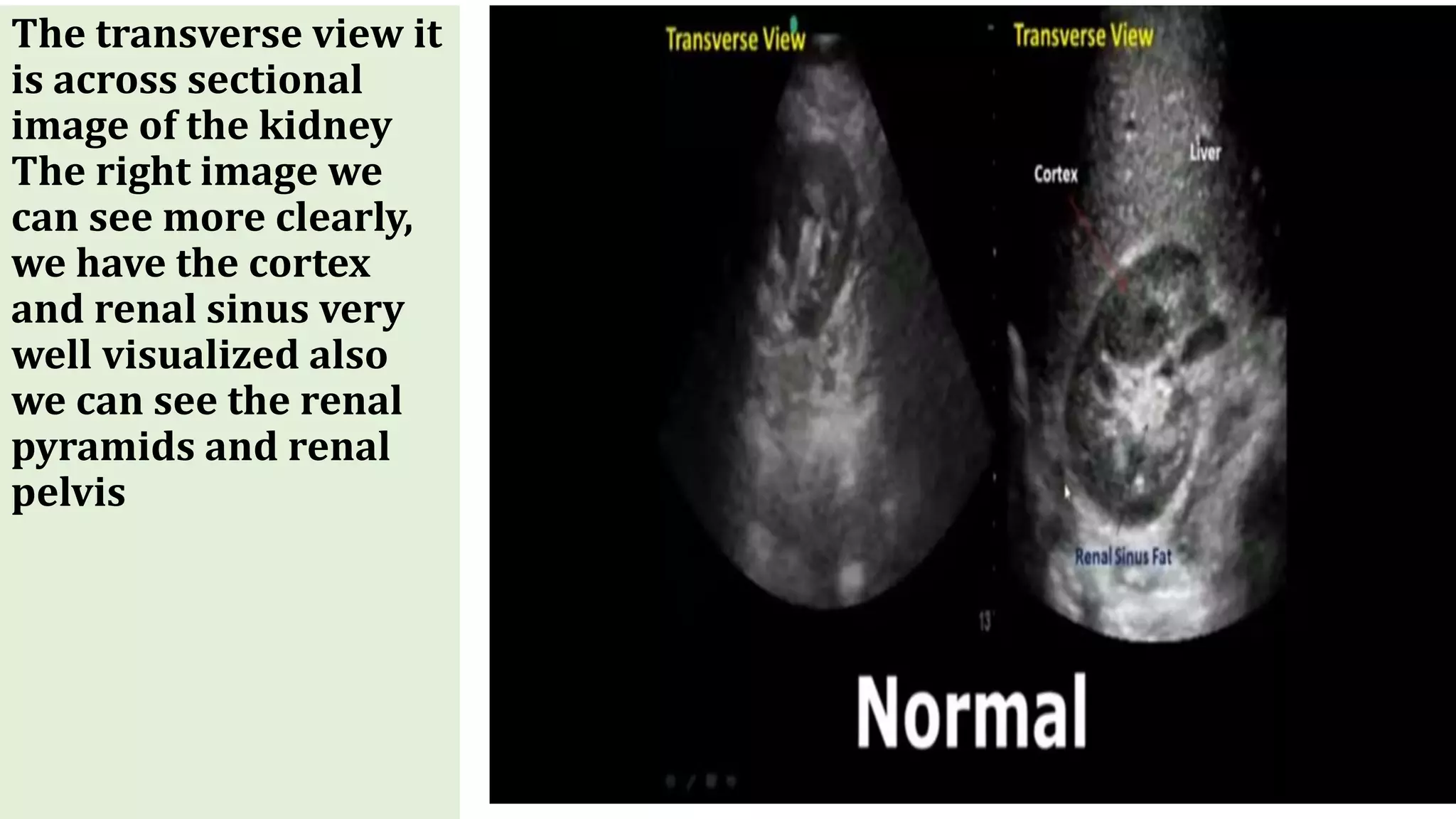 renal ultrasound.pptx
