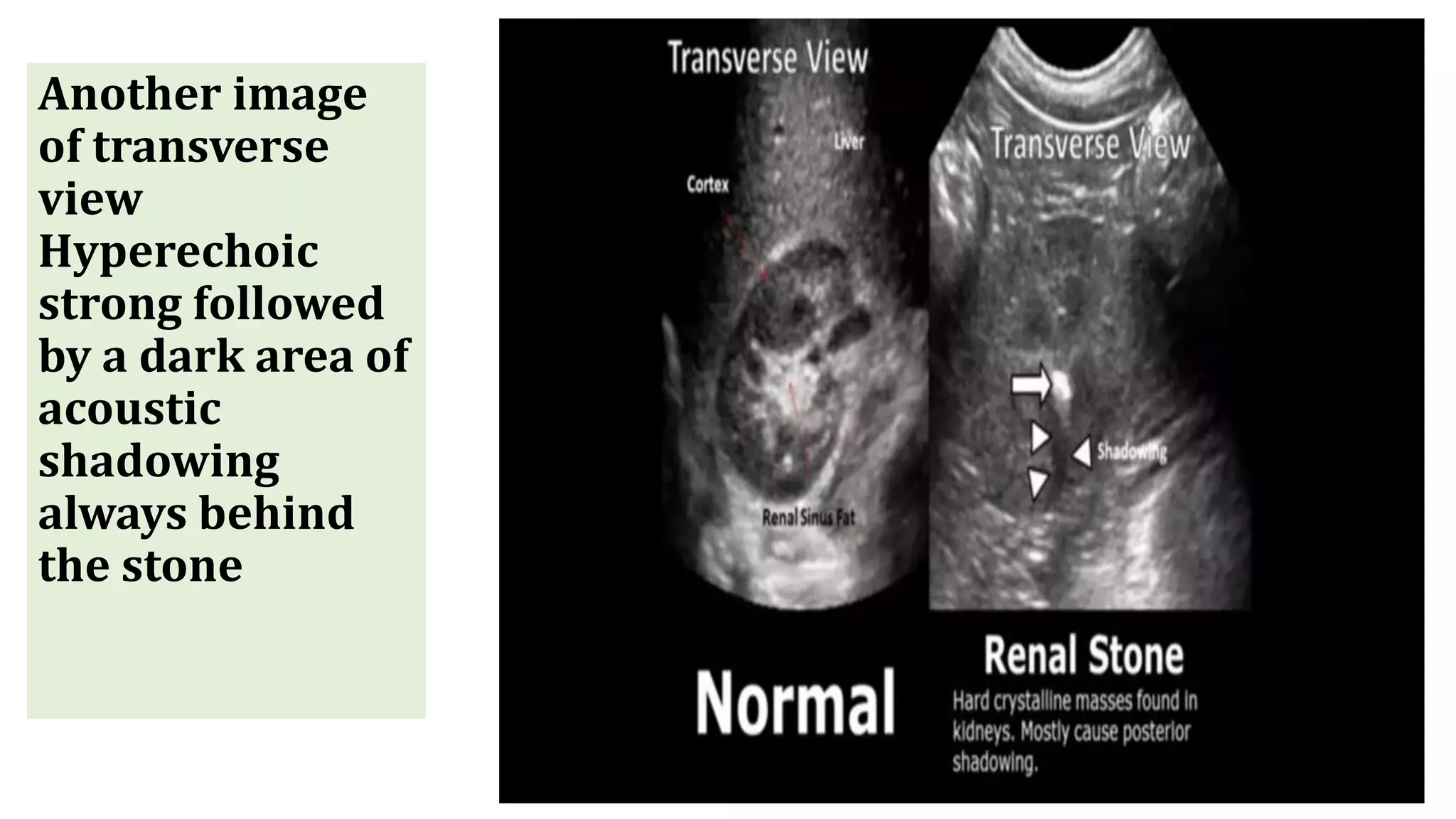 renal ultrasound.pptx
