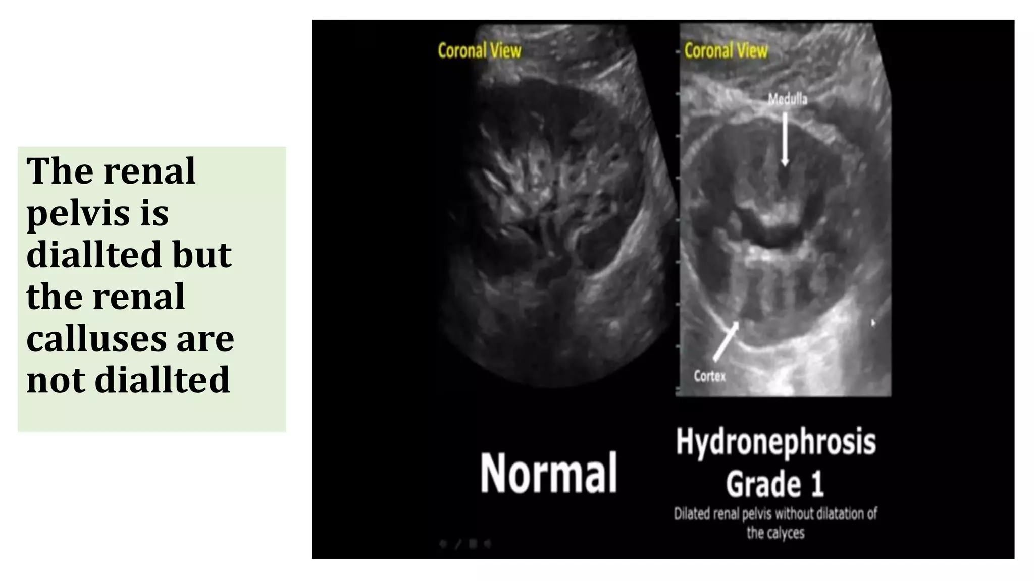 renal ultrasound.pptx