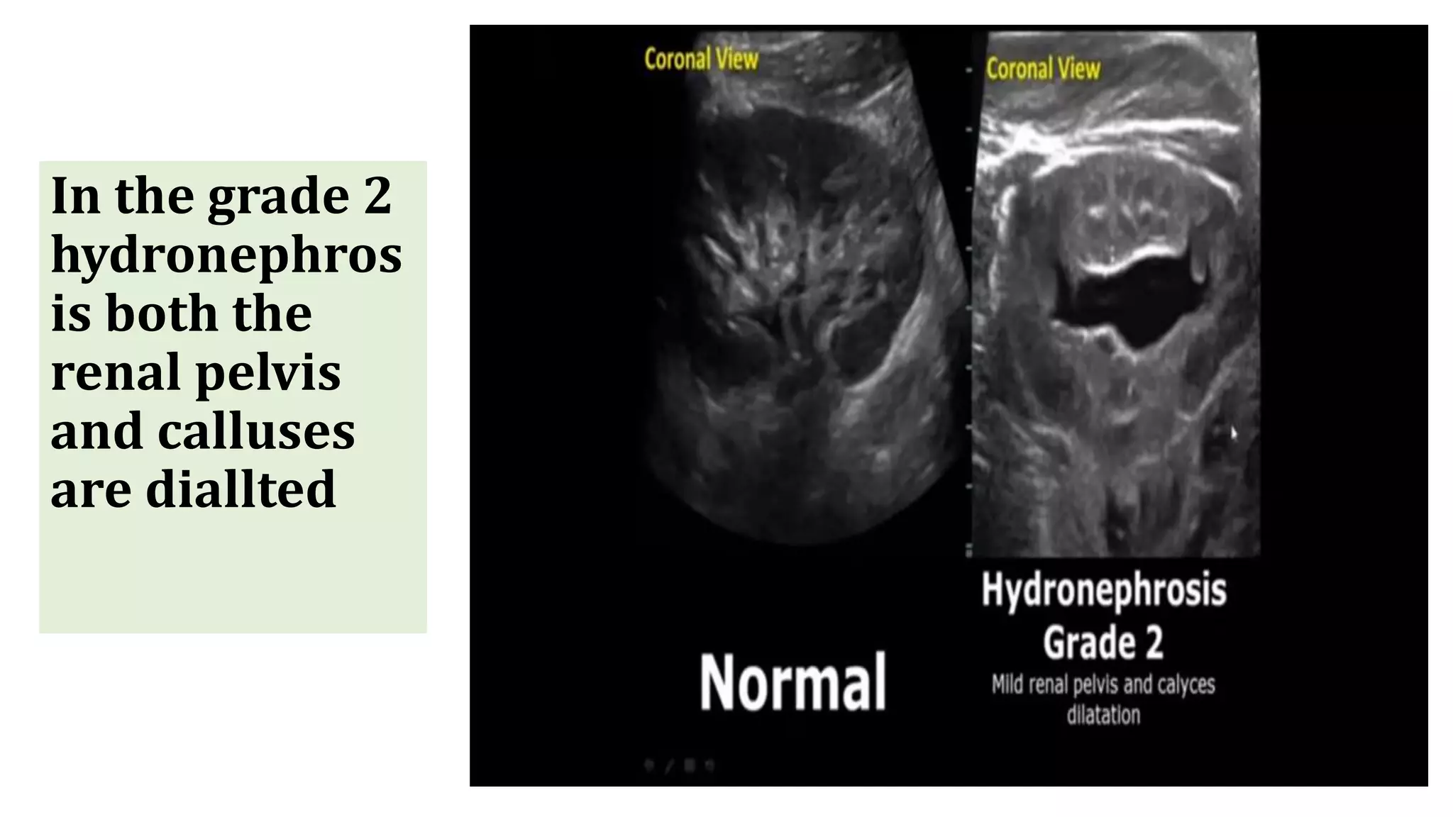 renal ultrasound.pptx