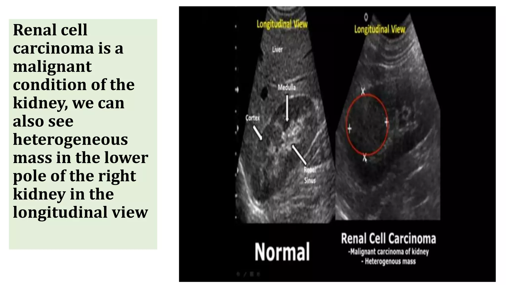 renal ultrasound.pptx