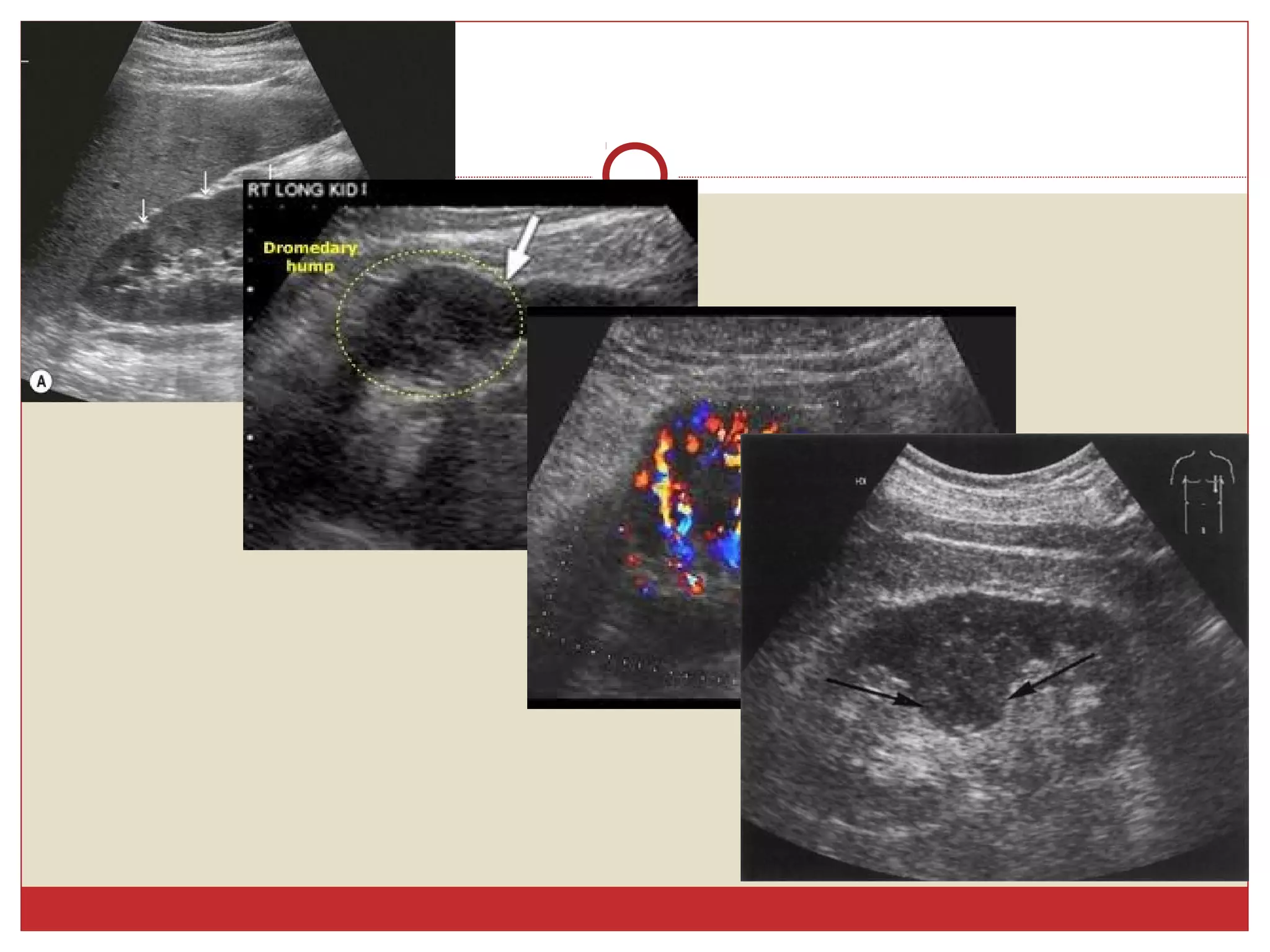 Renal us dr.doaa sharaf md | PPT