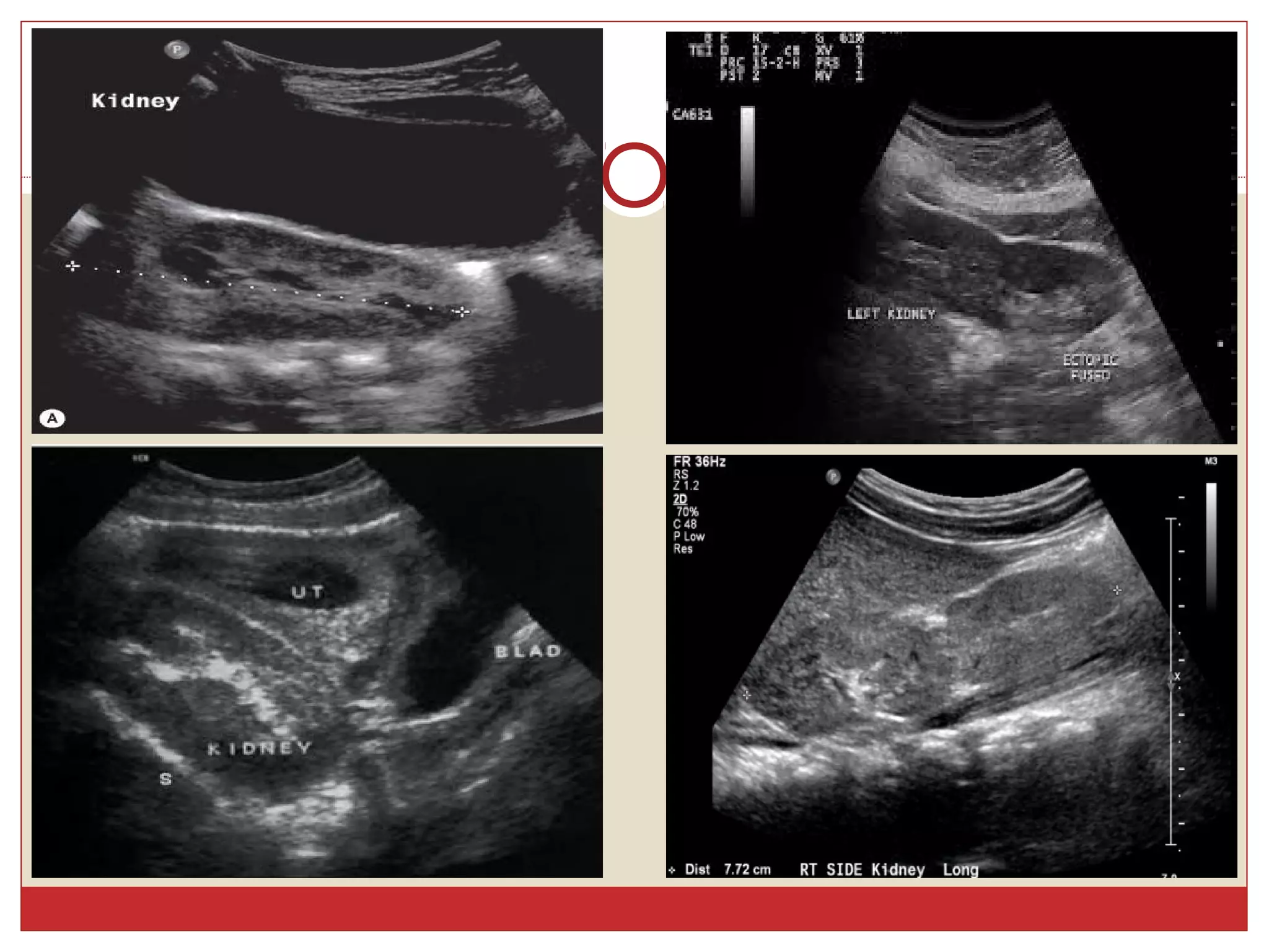 Renal us dr.doaa sharaf md | PPT