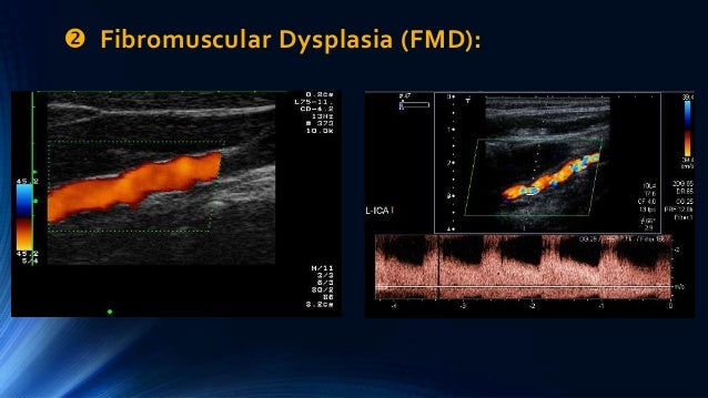 Renal vascular disease