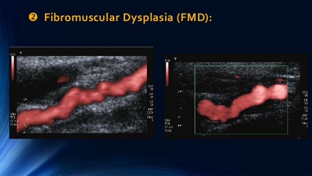Renal vascular disease