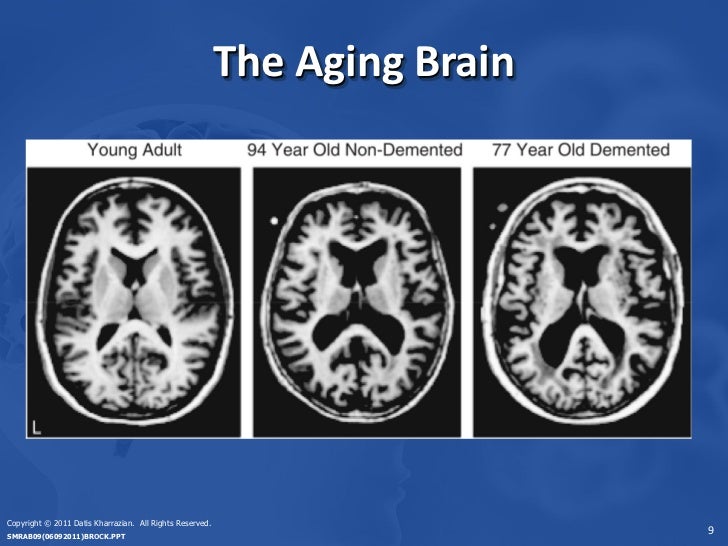 Renewing the Aging Brain