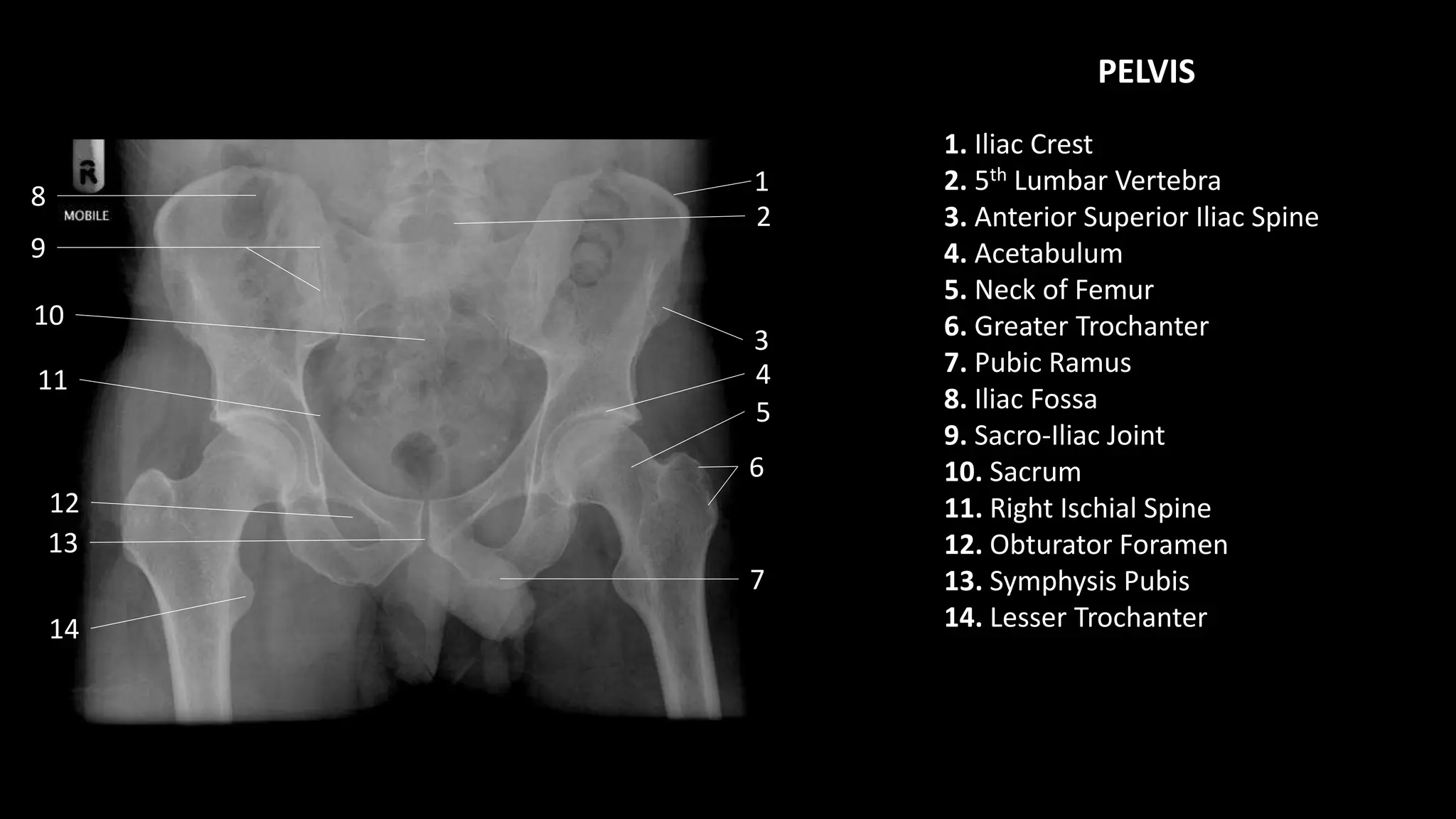 Slide Xray(Pelvis) for Radiation Therapy Programme | PPTX