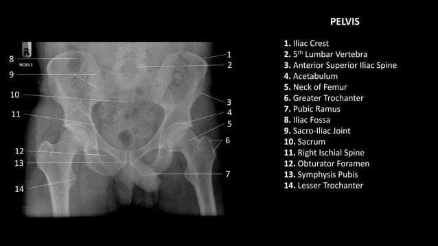 Slide Xray(Pelvis) for Radiation Therapy Programme | PPTX