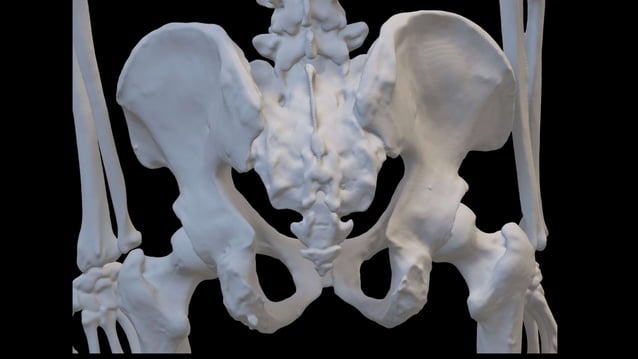 Slide Xray(Pelvis) for Radiation Therapy Programme | PPTX