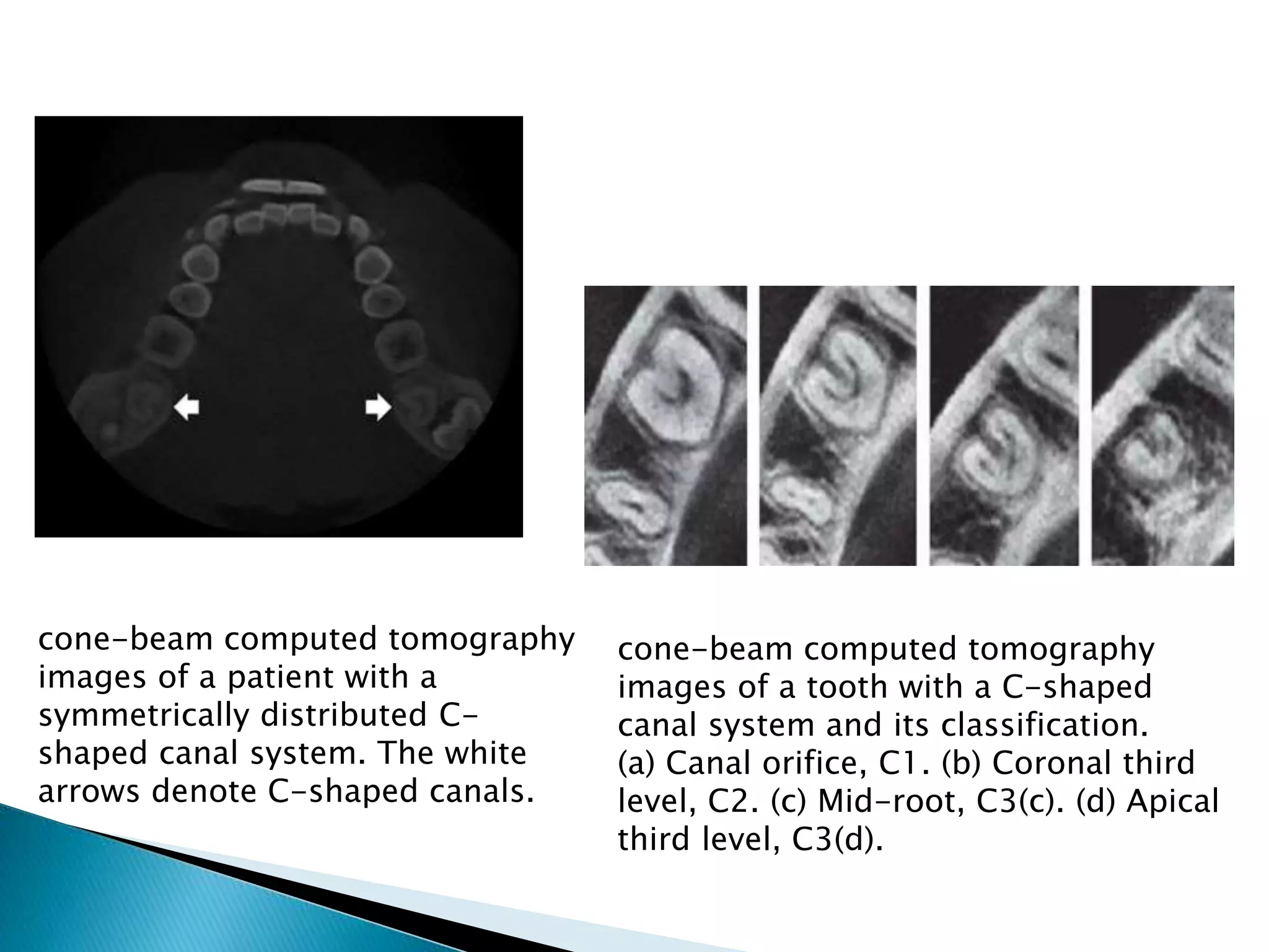 Renjith c shaped canal configuration | PPTX