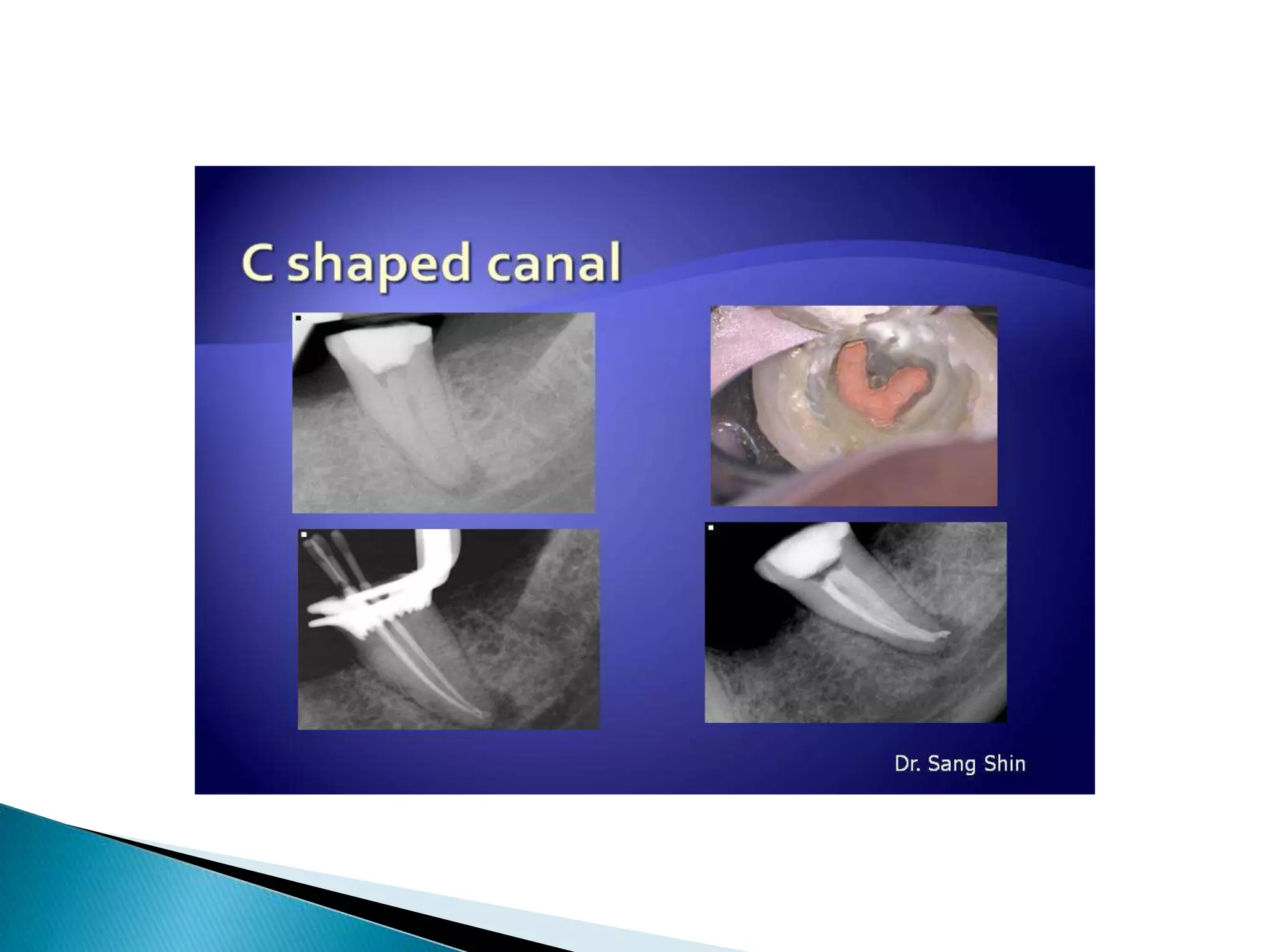 Renjith c shaped canal configuration | PPTX