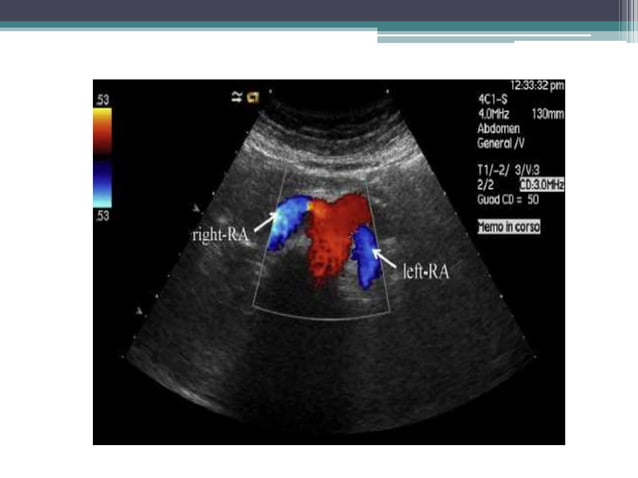 RenoVascular Hypertension in clinical.pptx | Heart and Cardiovascular ...