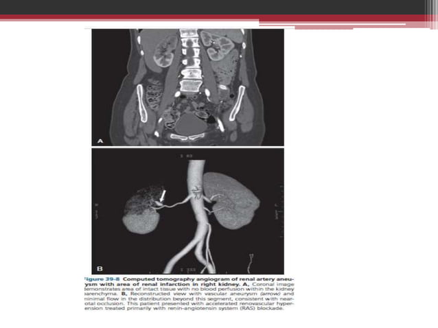 Renovascular hypertension(rvh) | PPTX