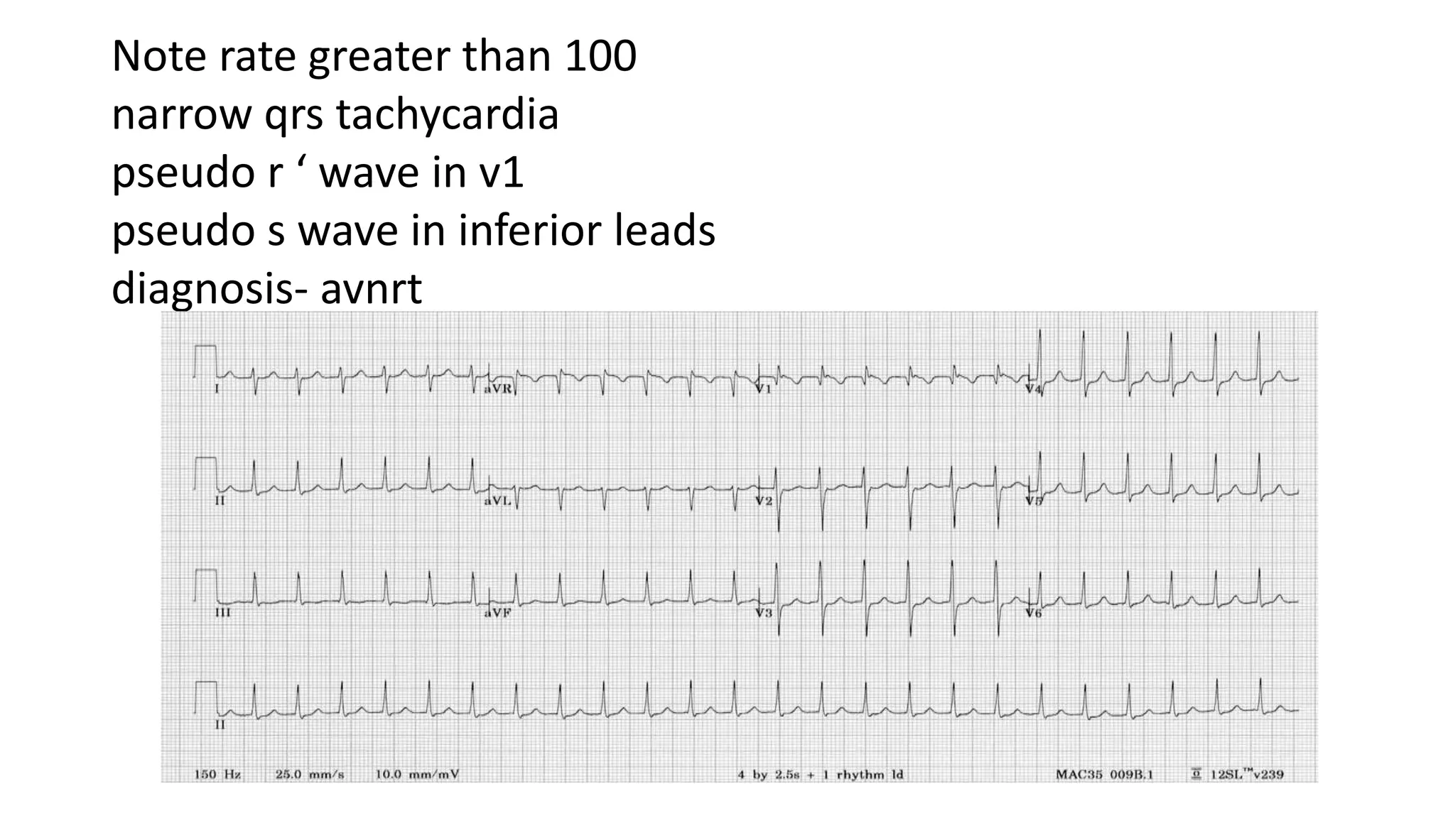 NARROW QRS TACHYCARDIA PART II | PPTX