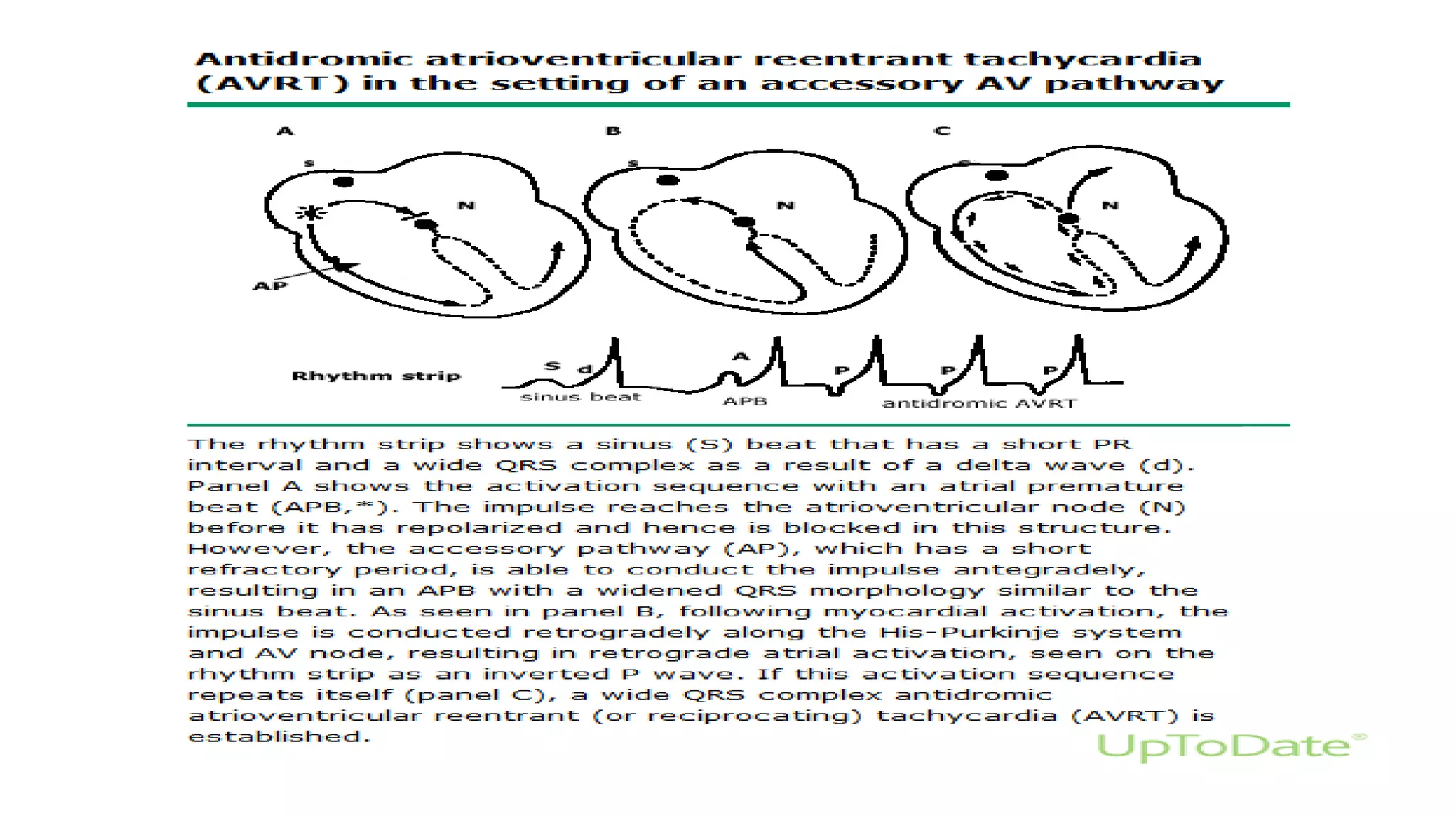 NARROW QRS TACHYCARDIA PART II | PPTX