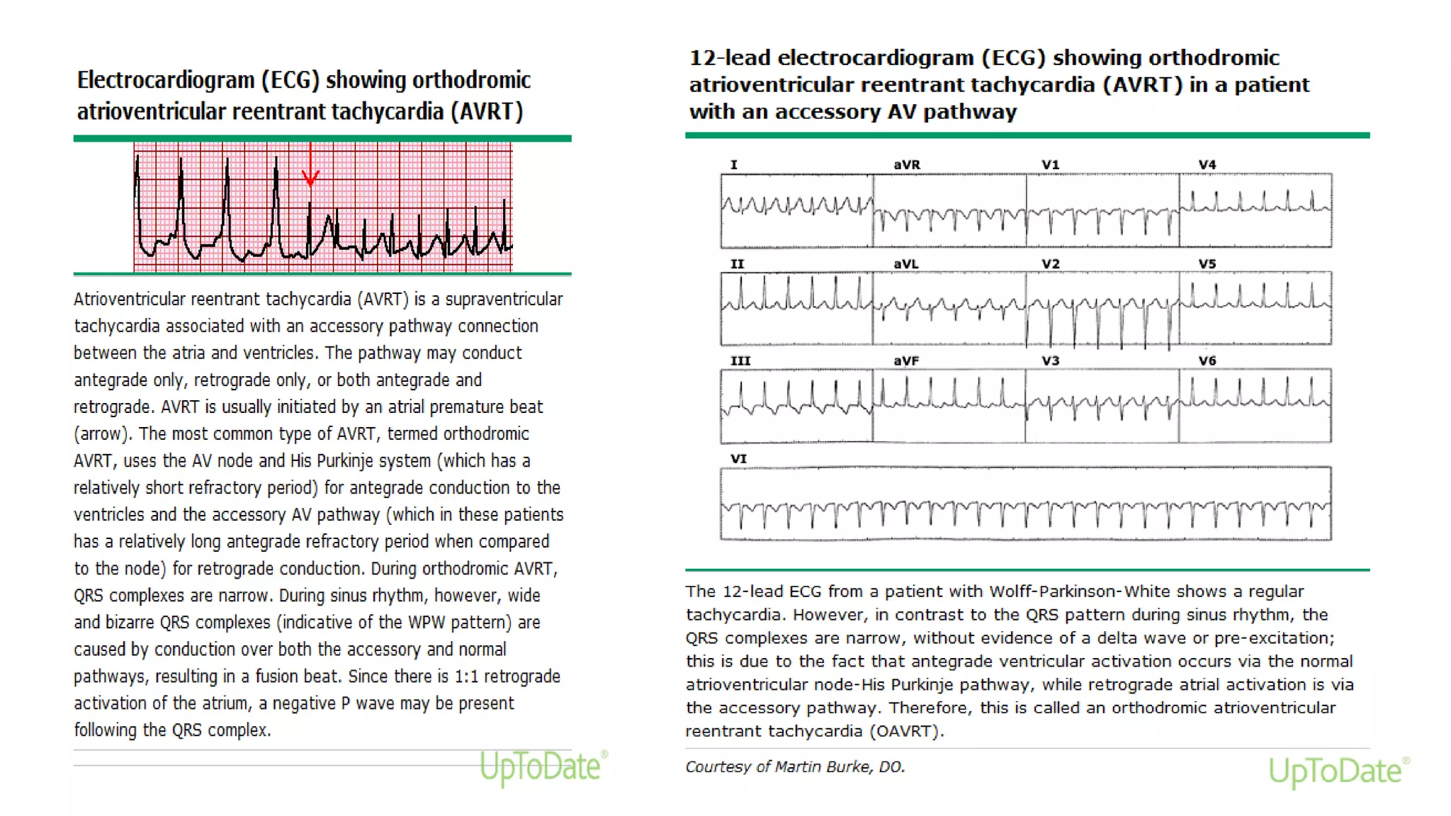 NARROW QRS TACHYCARDIA PART II | PPTX