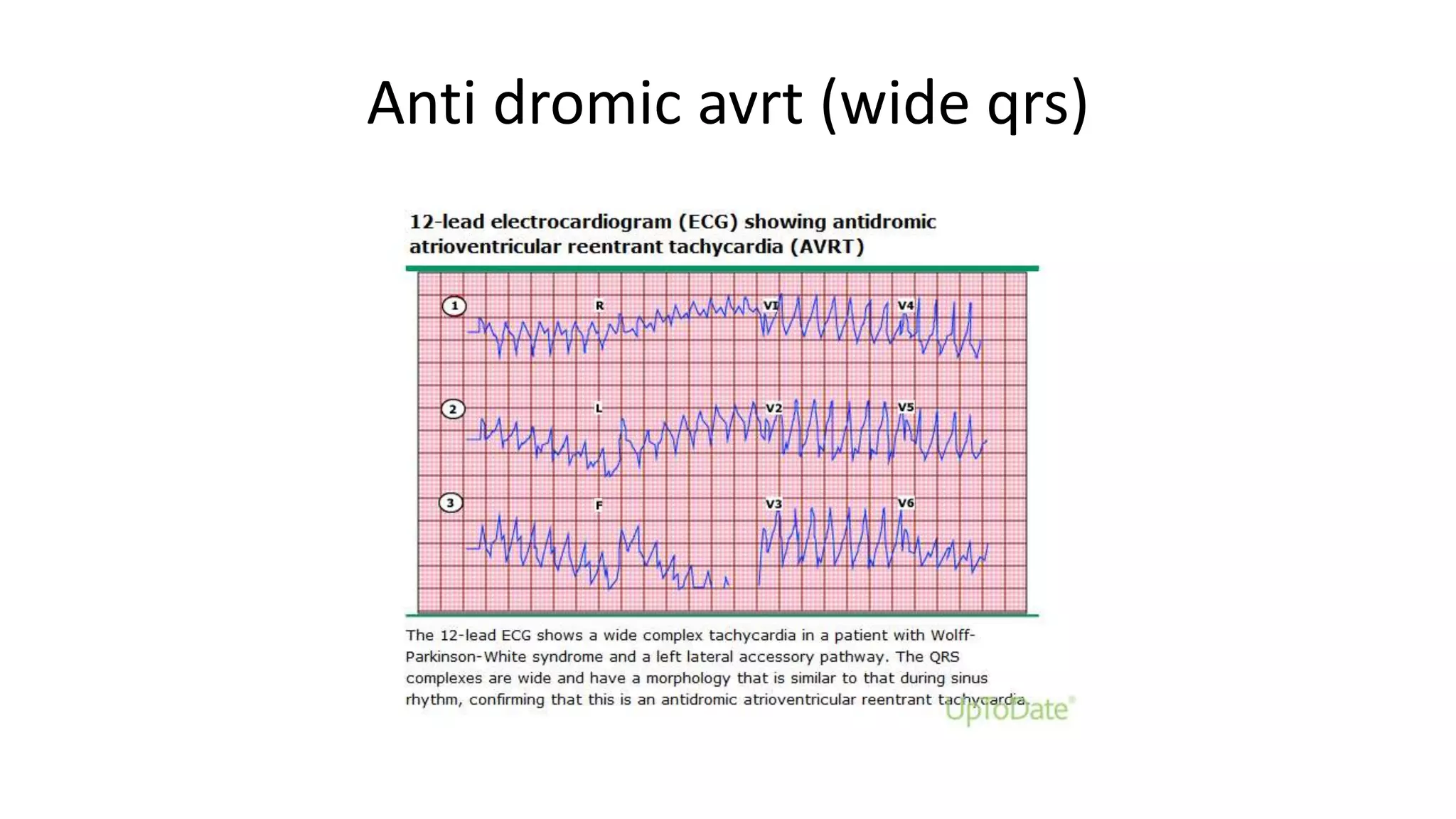 NARROW QRS TACHYCARDIA PART II | PPTX