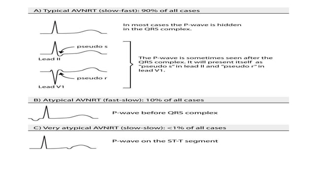 NARROW QRS TACHYCARDIA PART II | PPT