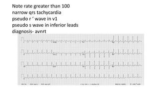 NARROW QRS TACHYCARDIA PART II | PPTX