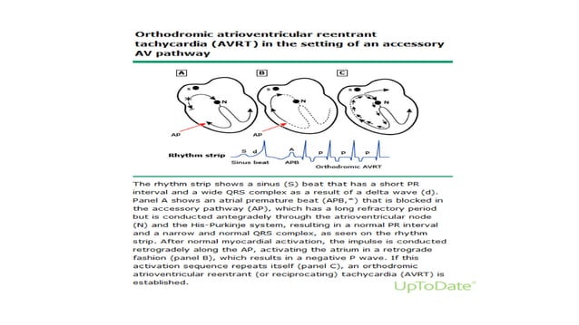 NARROW QRS TACHYCARDIA PART II | PPT