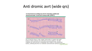 NARROW QRS TACHYCARDIA PART II | PPTX