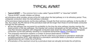 NARROW QRS TACHYCARDIA PART II | PPTX