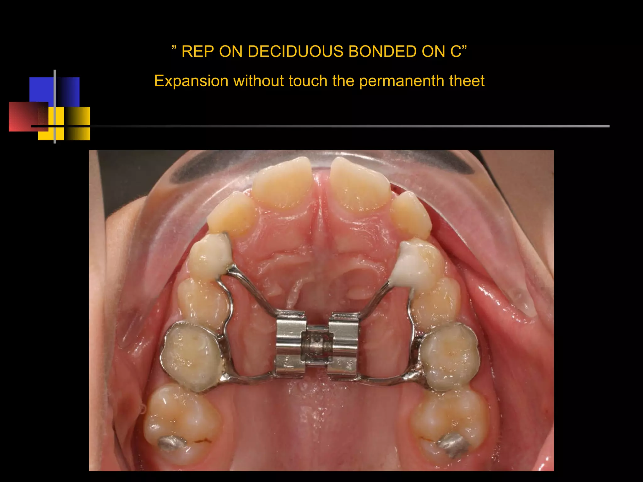 Expansion on Deciduous Teeth | PPT