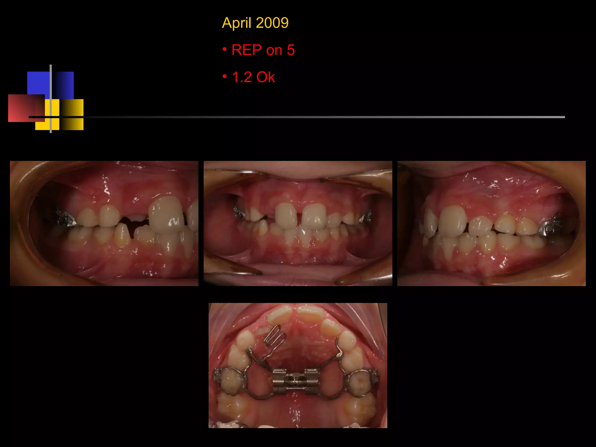 Expansion on Deciduous Teeth | PPT