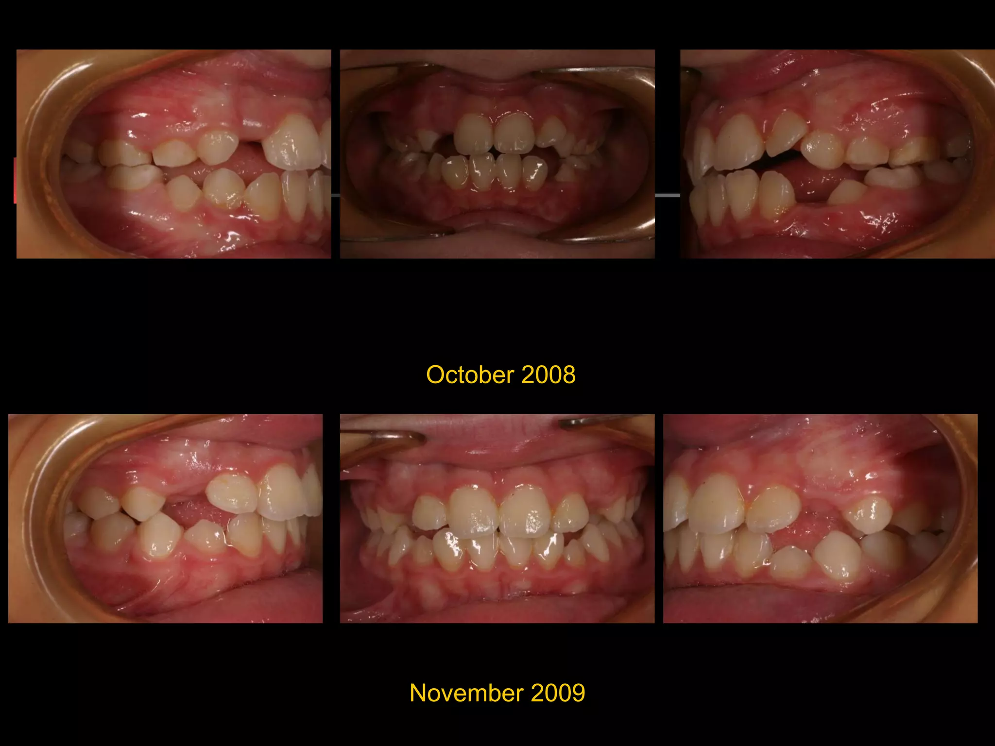 Expansion on Deciduous Teeth | PPT