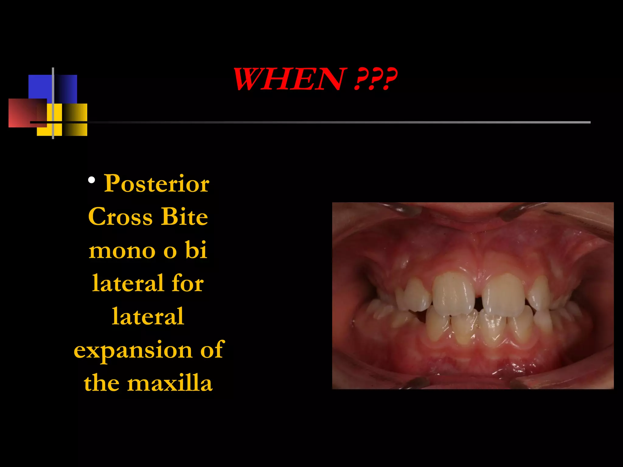 Expansion on Deciduous Teeth | PPT
