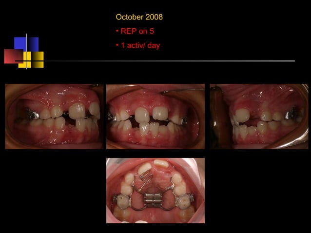 Expansion on Deciduous Teeth | PPT