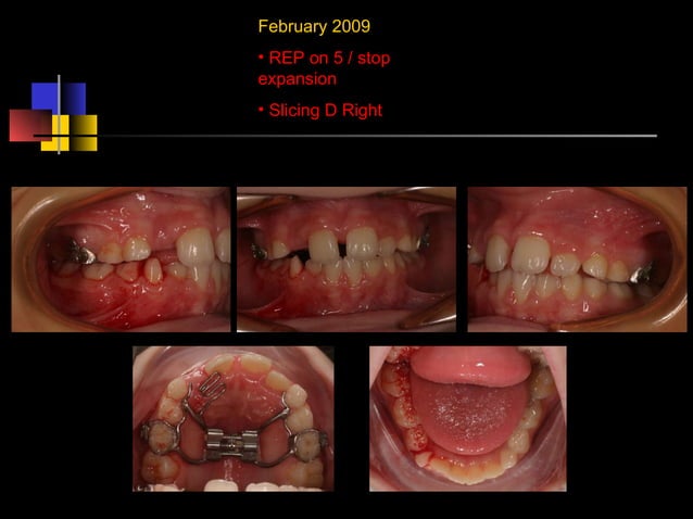 Expansion on Deciduous Teeth | PPT