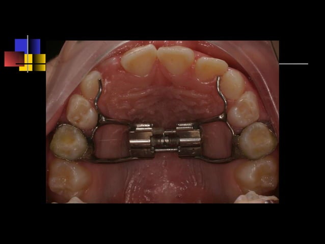 Expansion on Deciduous Teeth | PPT