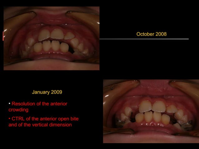 Expansion on Deciduous Teeth | PPT