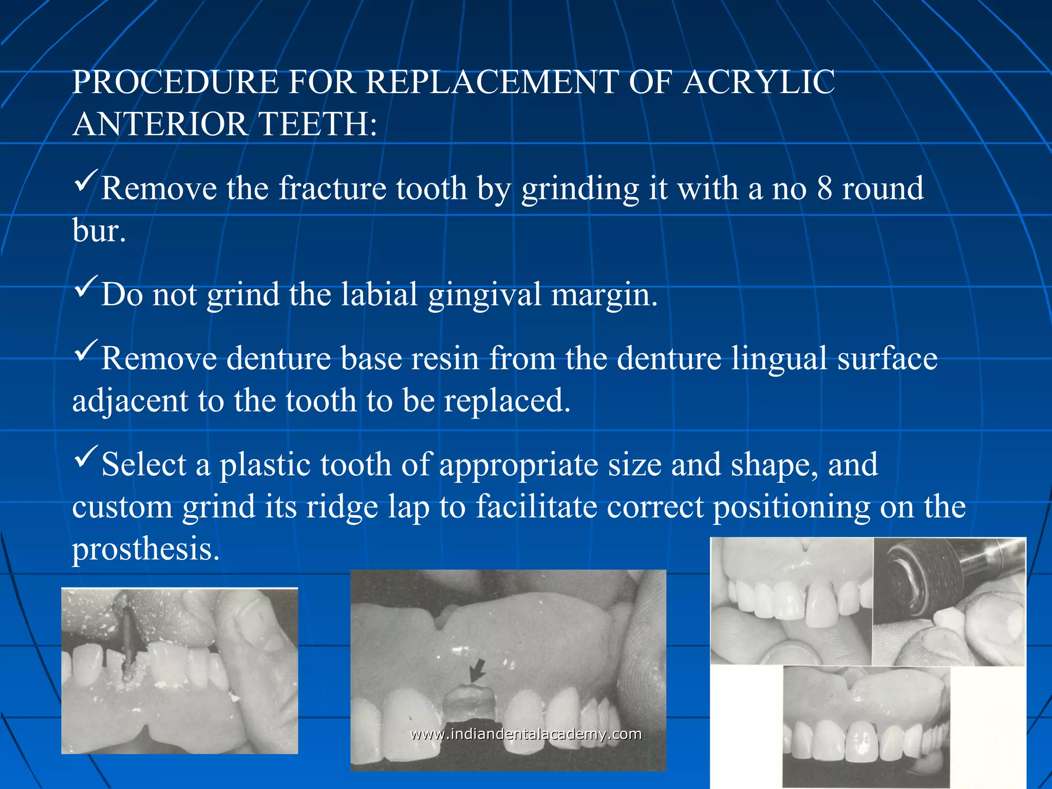 Repair of complete dentures/ Labial orthodontics | PPT