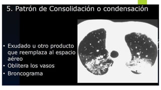 Repaso tacar toracica y patrones | PDF