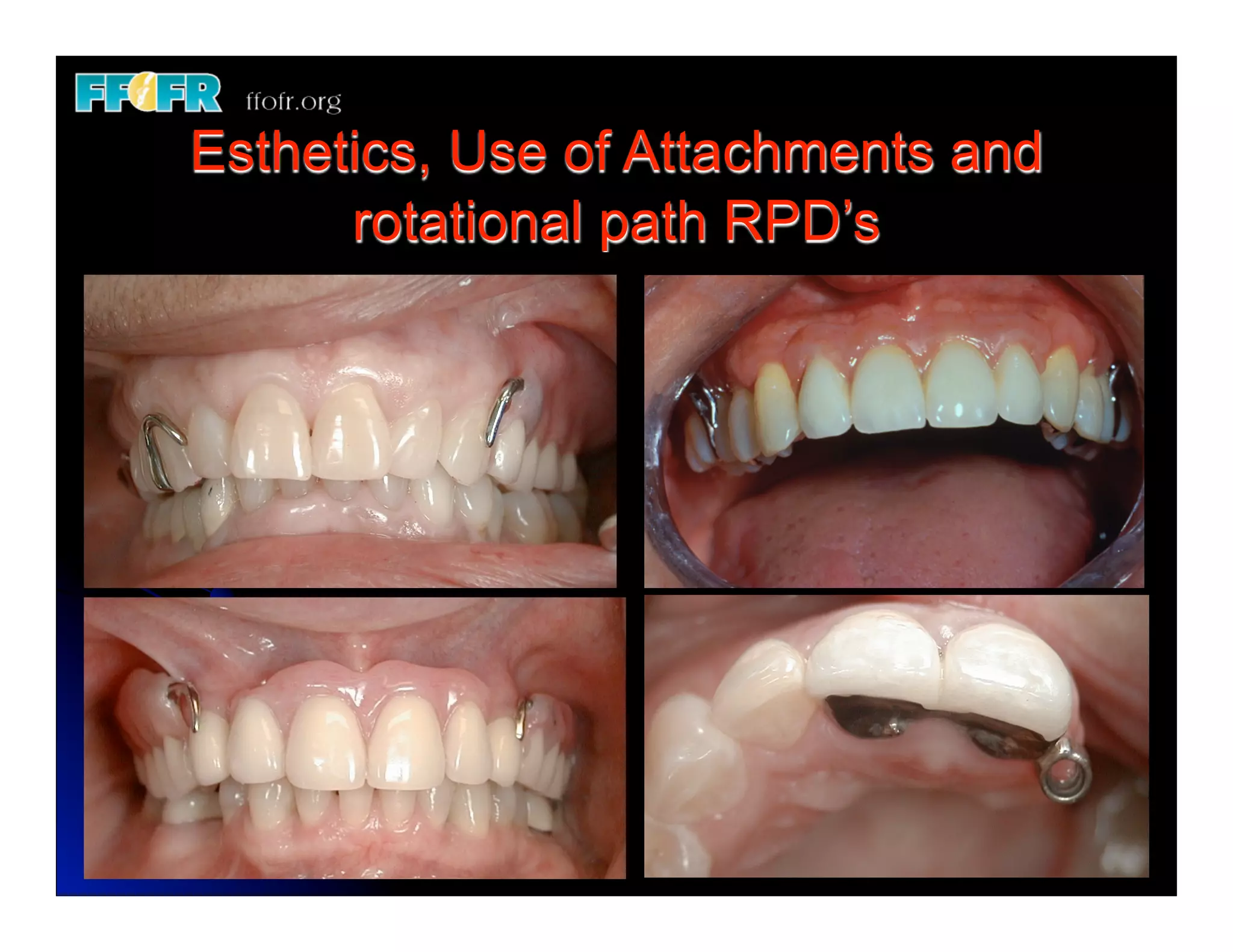 (Replace) 11.esthetics, rotational path, attachments | PDF