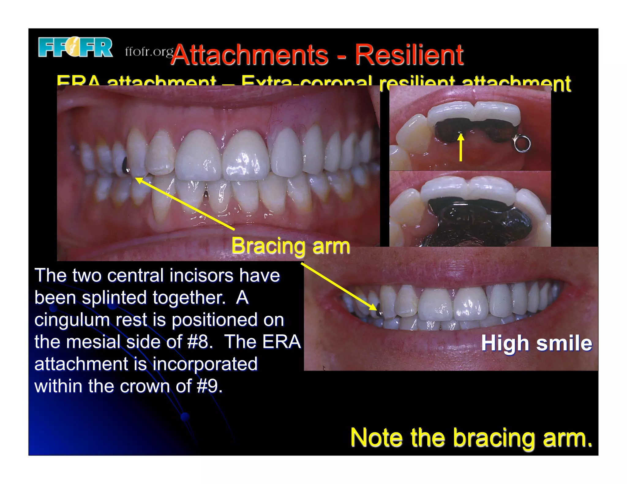 (Replace) 11.esthetics, rotational path, attachments | PDF