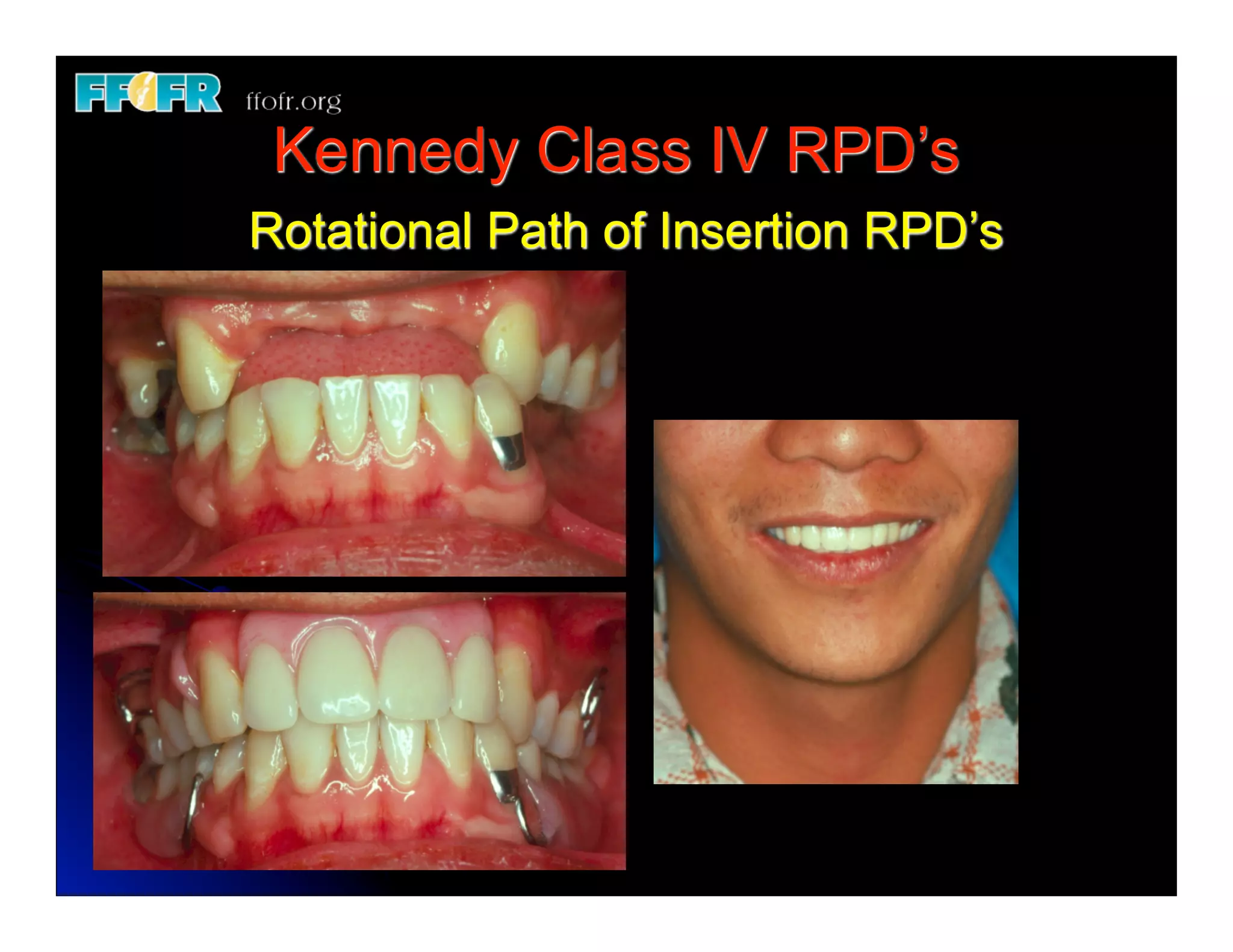 (Replace) 11.esthetics, rotational path, attachments | PDF