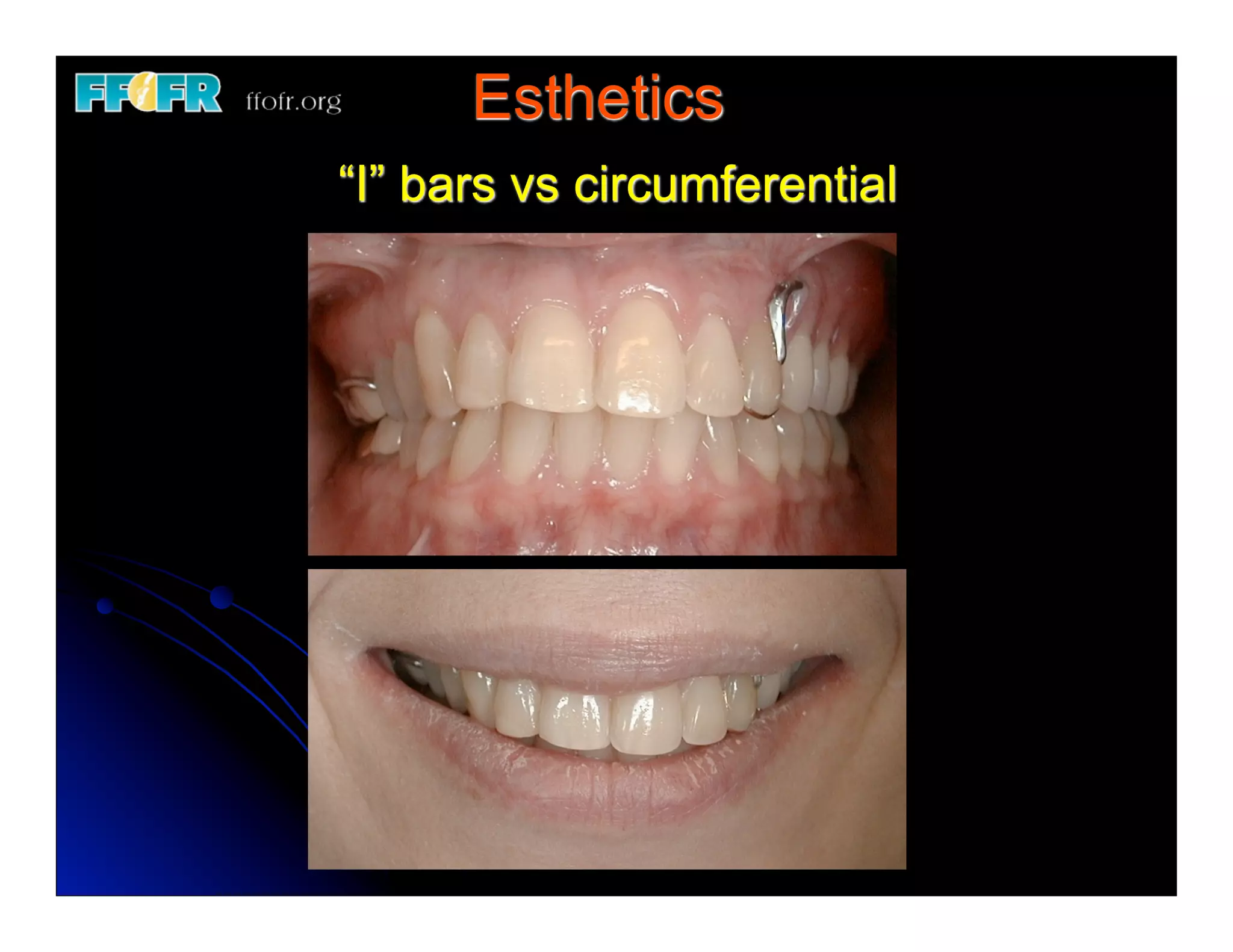 (Replace) 11.esthetics, rotational path, attachments | PDF