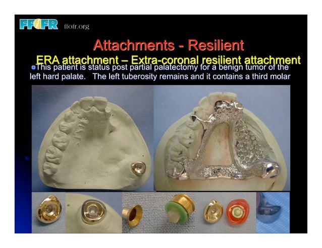 (Replace) 11.esthetics, rotational path, attachments | PPT