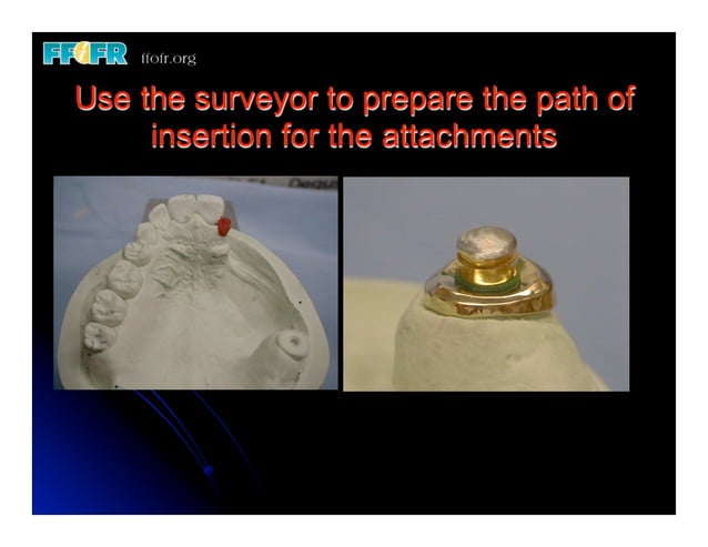 (Replace) 11.esthetics, rotational path, attachments | PPT