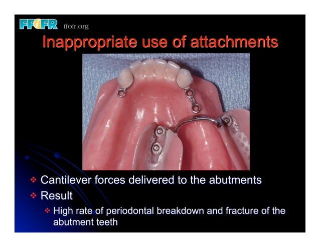 (Replace) 11.esthetics, rotational path, attachments | PPT