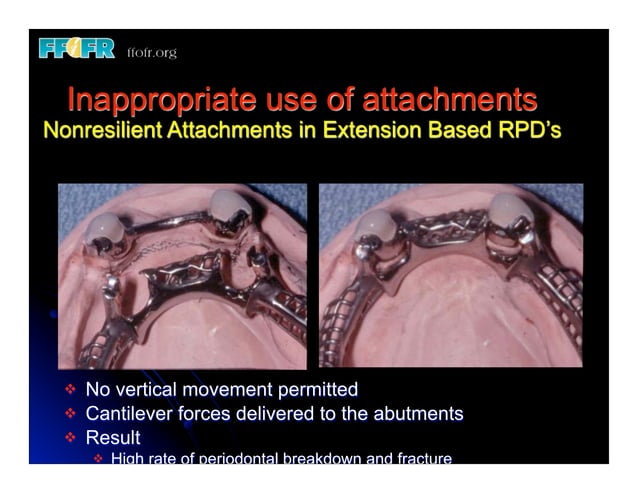 (Replace) 11.esthetics, rotational path, attachments | PPT